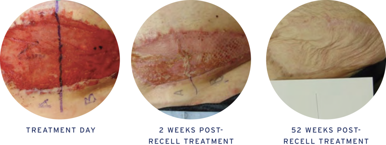 Patient Outcomes - AVITA Medical, Inc.