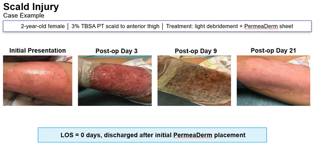 Wound Management with a Biosynthetic Wound Matrix